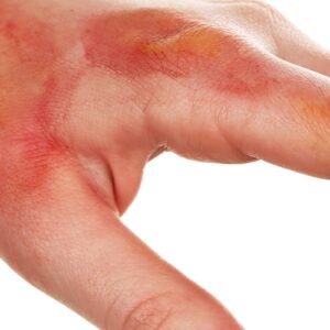 Heal Hand Burns in Fort Myers, FL at Cascade Hand & Orthopedic Rehab